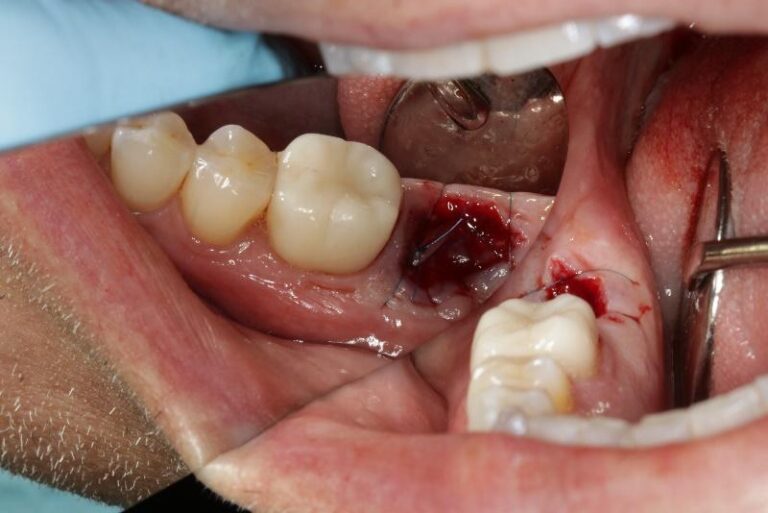 Alveolar Socket Management - BioCellgraft