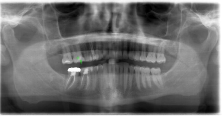 Alveolar Socket Management - BioCellgraft