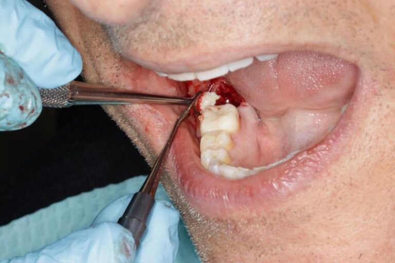 Alveolar Socket Management - BioCellgraft